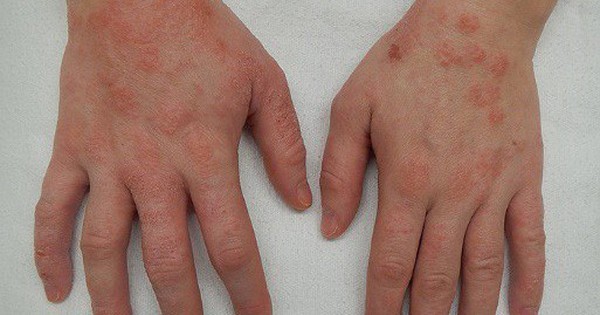 Cách chữa trị bệnh lichen đơn dạng mãn tính hiệu quả tại nhà